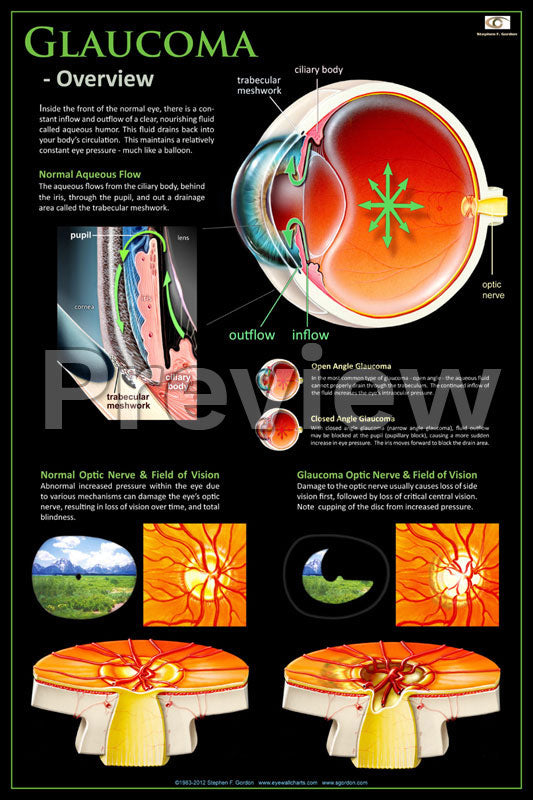 Glaucoma Overview Poster – Eye Flip Charts by Stephen F. Gordon